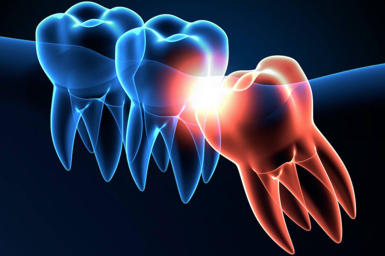Impaktirani umnjaci - uzroci, simptomi, liječenje - Smile Studio