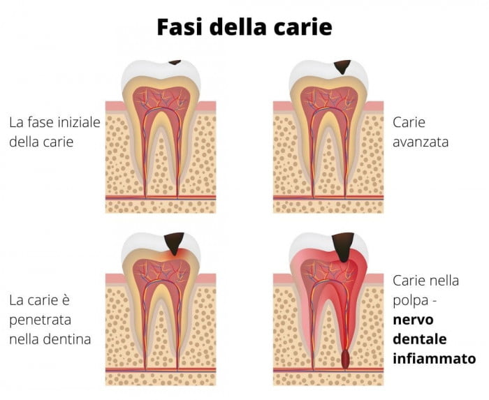 Pulpite: quali sono i sintomi e come trattarla - Smile Studio