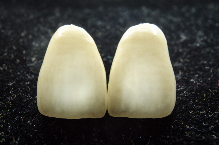 Usporedba metal-keramičkih, cirkon-keramičkih i staklo-keramičkih ...