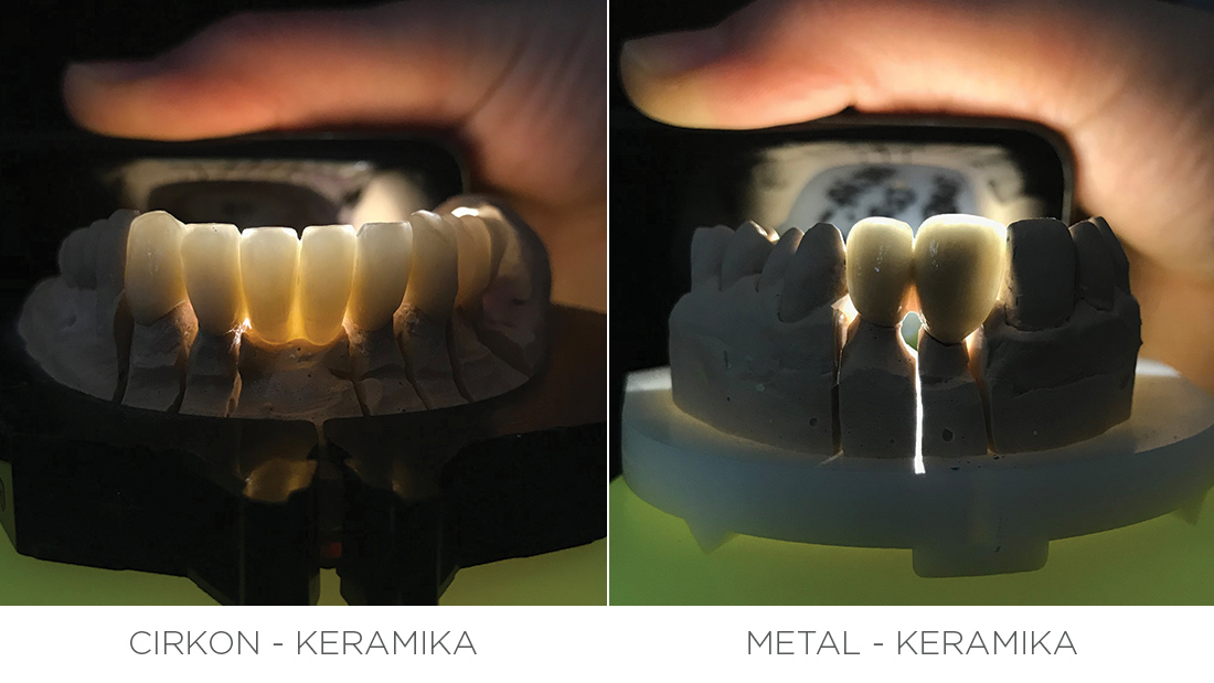 Zašto su cirkonske keramičke krunice najbolje rješenje za nadomjestak ...