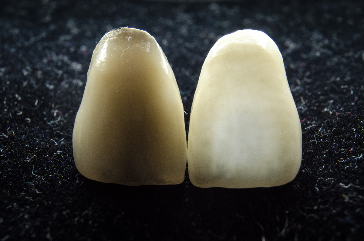 Metal keramičke ili cirkon keramičke - koje su zubne krunice najbolje ...